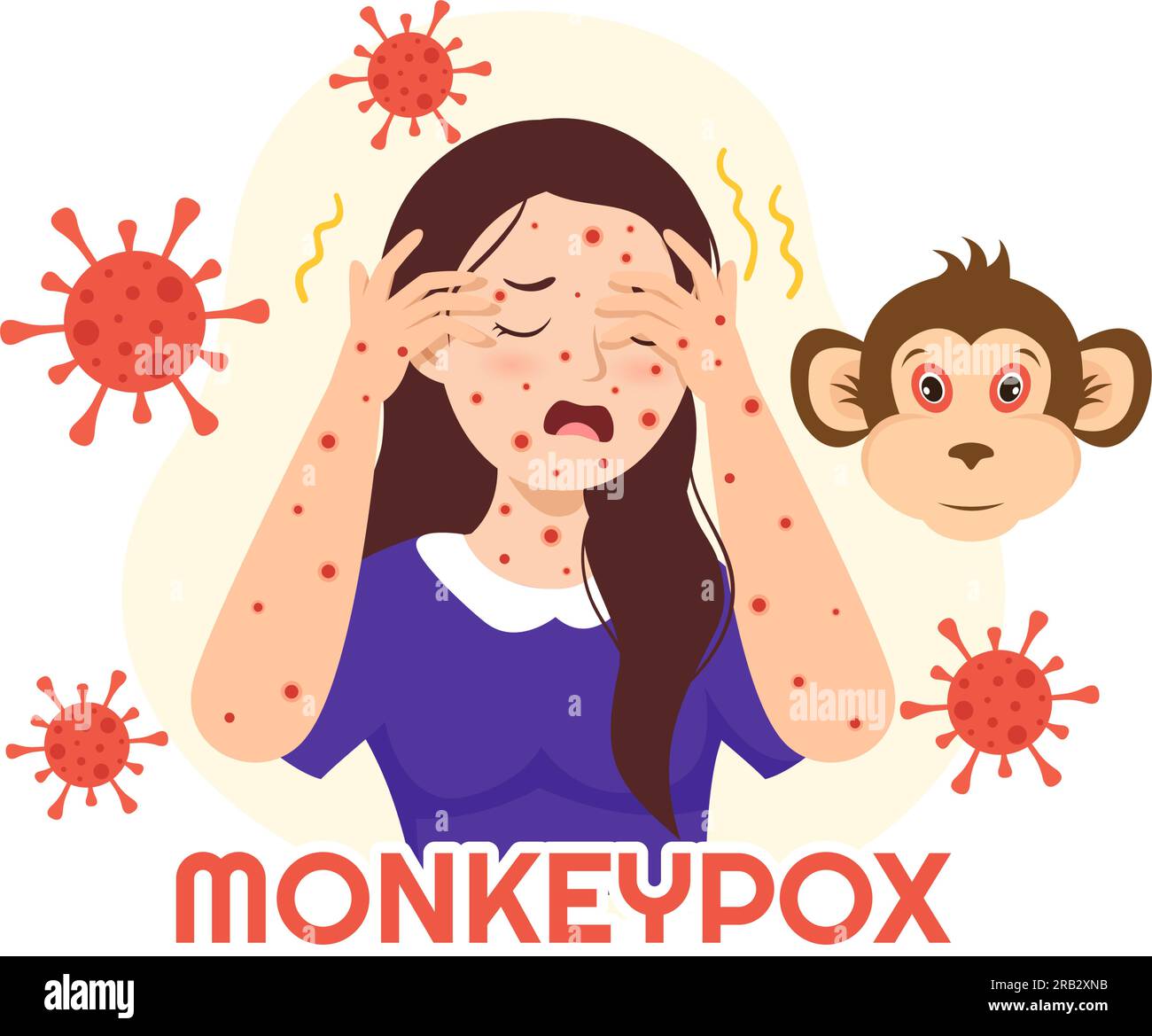 Monkey Pox Outbreak Vector Illustration of Virus Symptoms in Humans ...