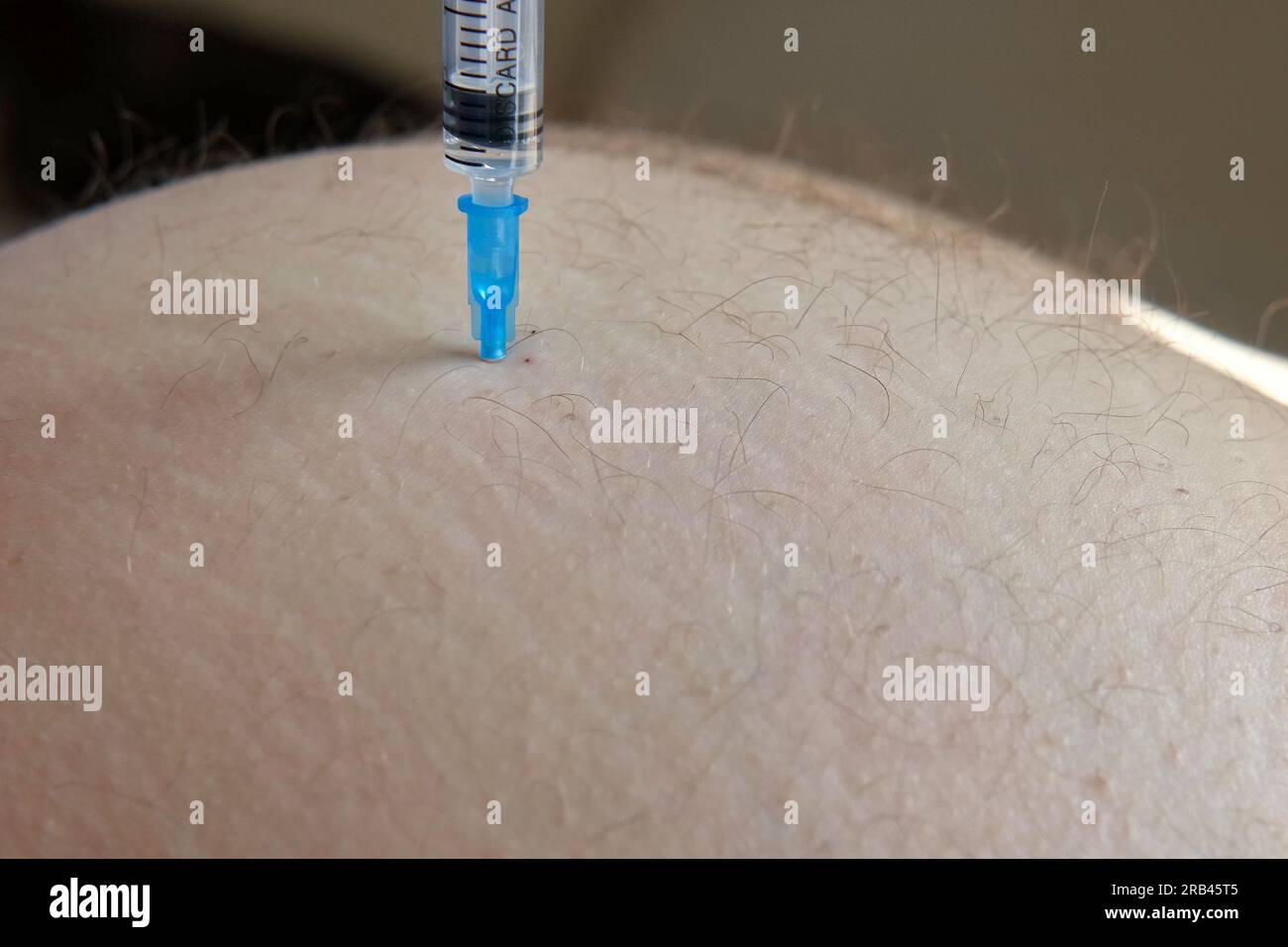 Needle injecting into the muscle. Nurse doing a trigger point injection ...