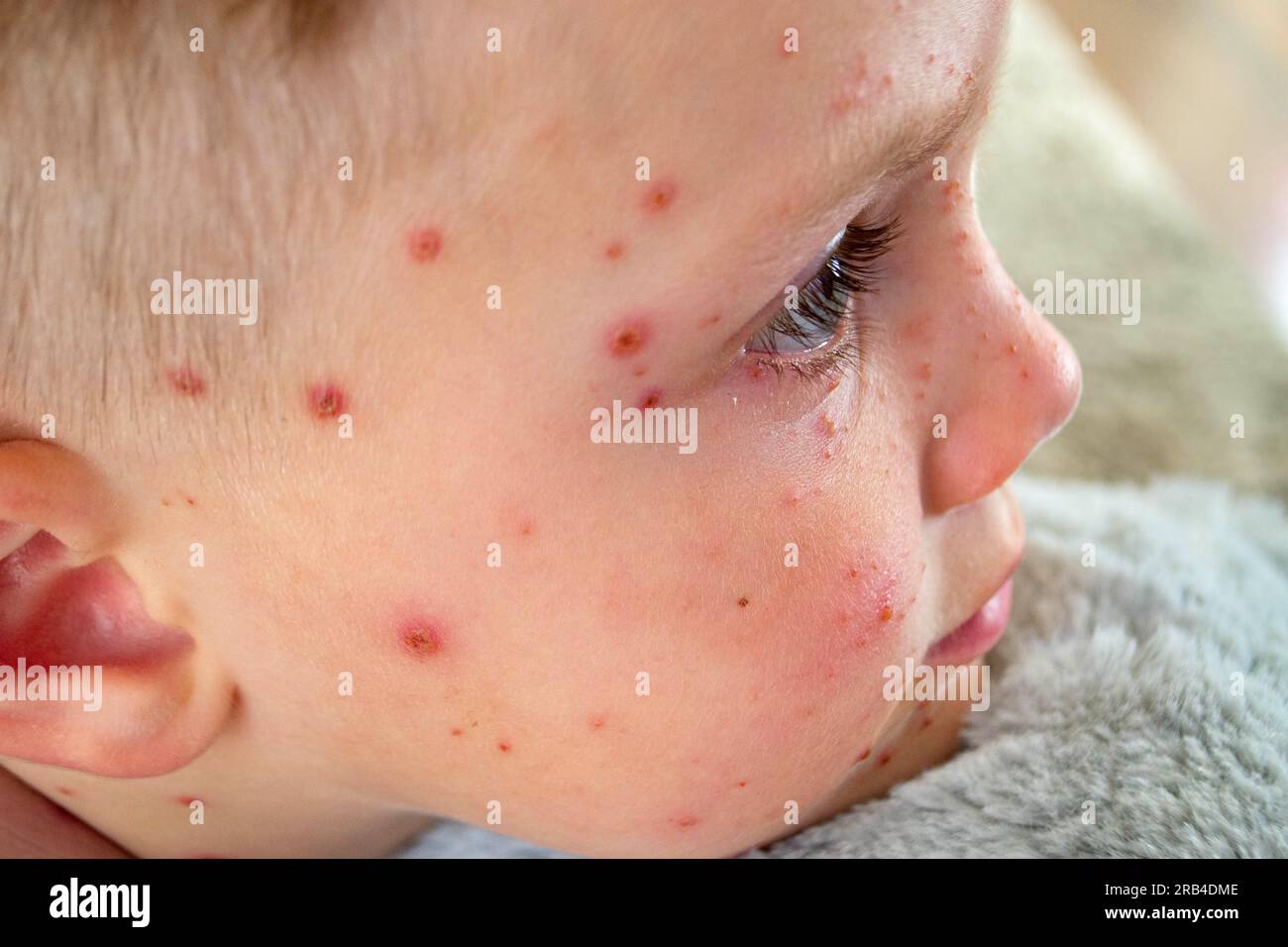 Natural vaccination. Contagious disease. Sick child with chickenpox ...