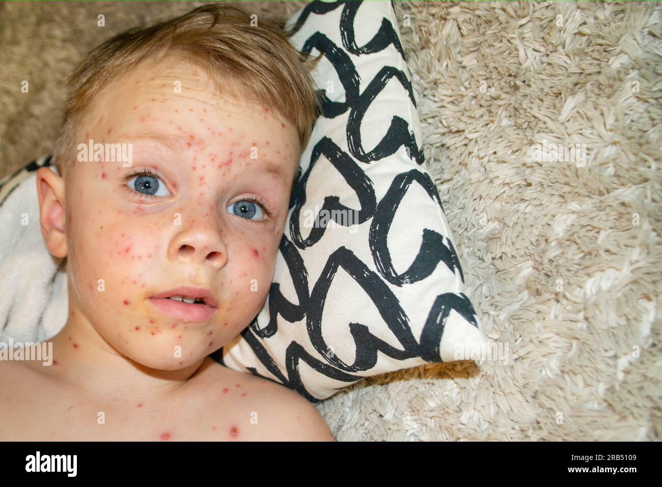Natural vaccination. Contagious disease. Sick child with chickenpox ...