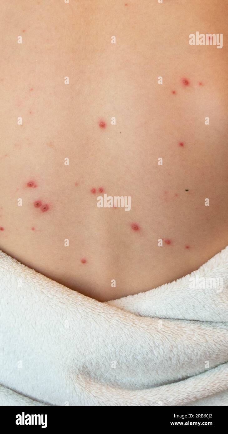 Natural vaccination. Contagious disease. Sick child with chickenpox ...