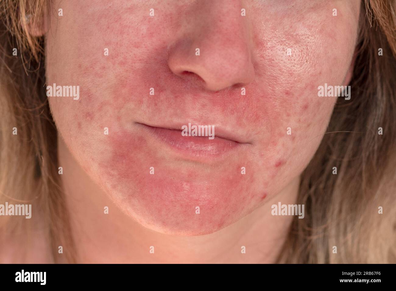 Scar skin feature hi-res stock photography and images - Alamy
