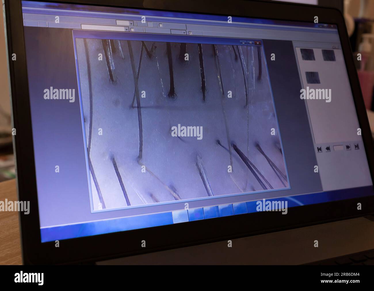 Compute Screen With Trichoscopy. Diagnosing Of Hair, Scalp Evaluation ...
