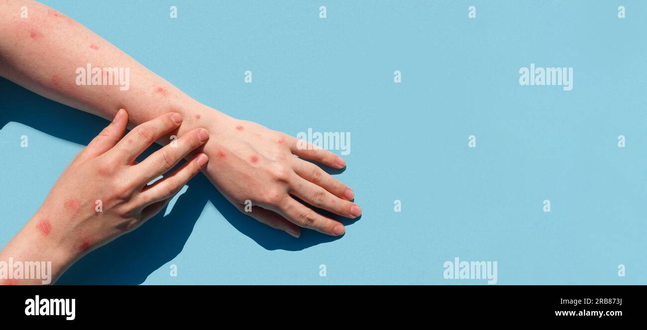 Monkeypox new disease dangerous over the world. Patient with Monkey Pox ...