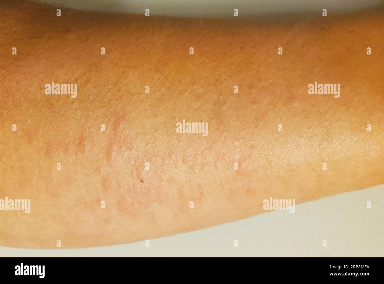 Itchy arm hi-res stock photography and images - Alamy
