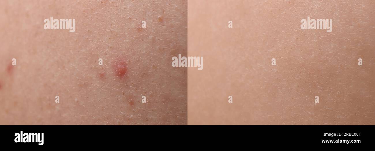 Collage with photos of person suffering from acne before and after ...