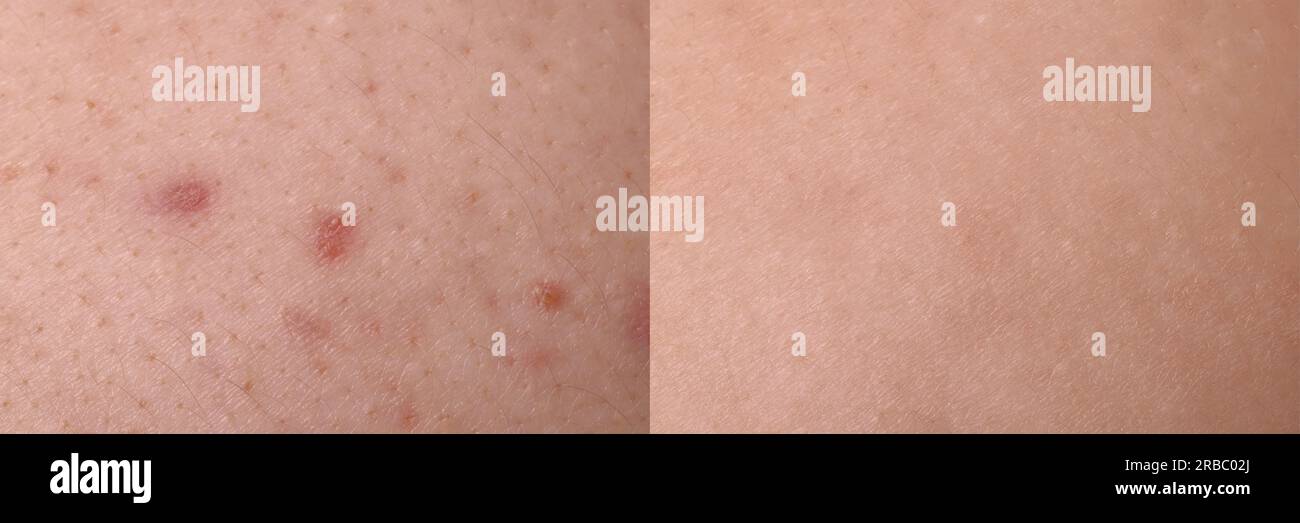 Collage with photos of person suffering from acne before and after ...