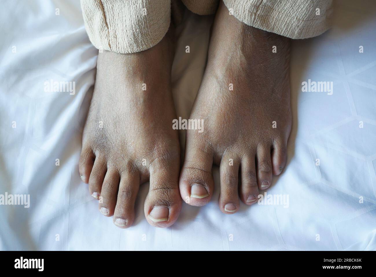 close up of women feet with swelling Stock Photo - Alamy