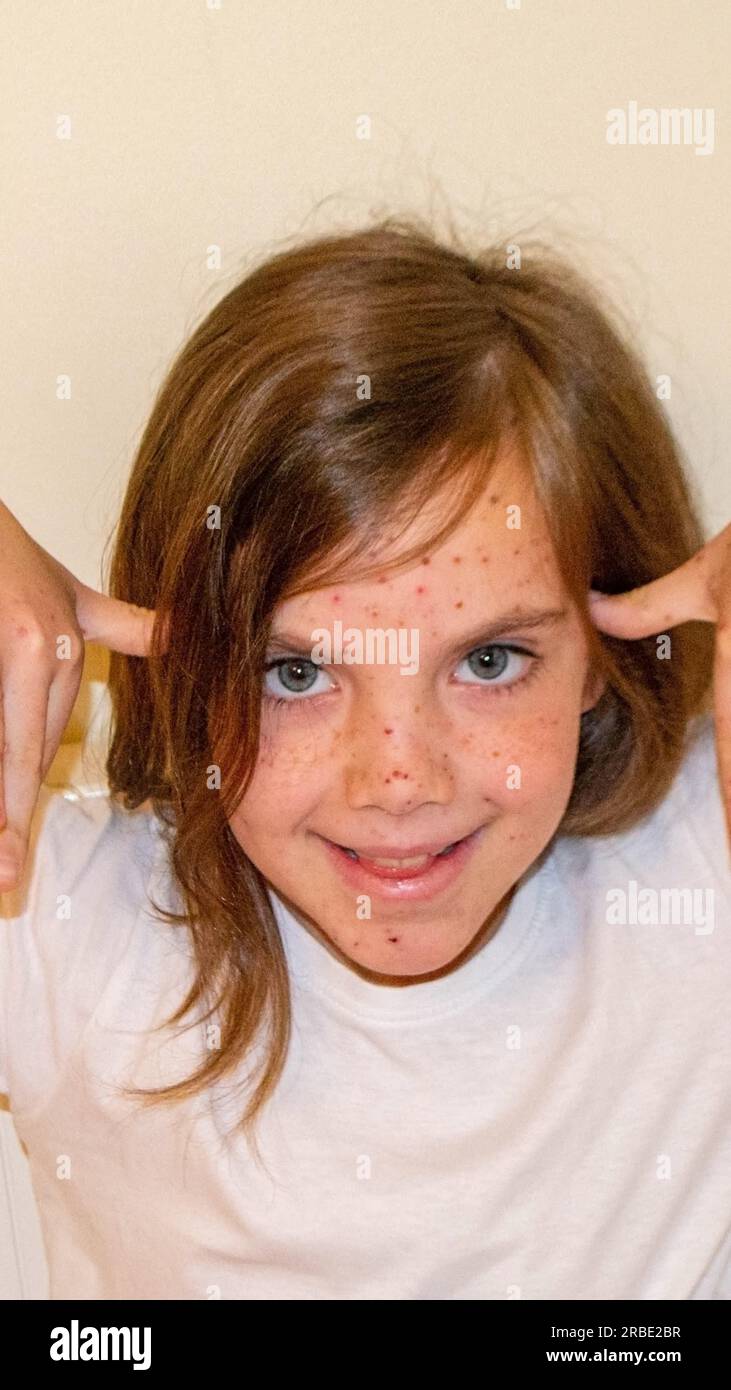 Natural vaccination. Contagious disease. Sick child with chickenpox ...