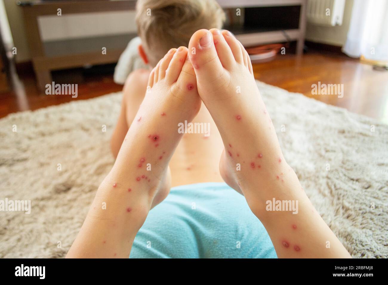 Natural vaccination. Contagious disease. Sick child with chickenpox ...