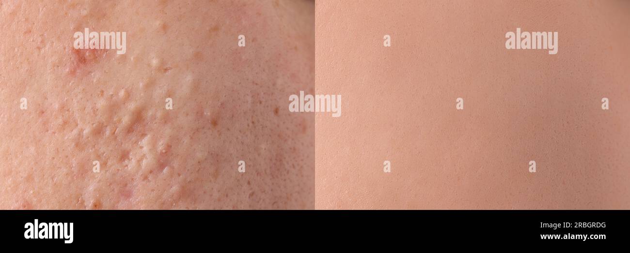 Collage with photos of person suffering from acne before and after ...