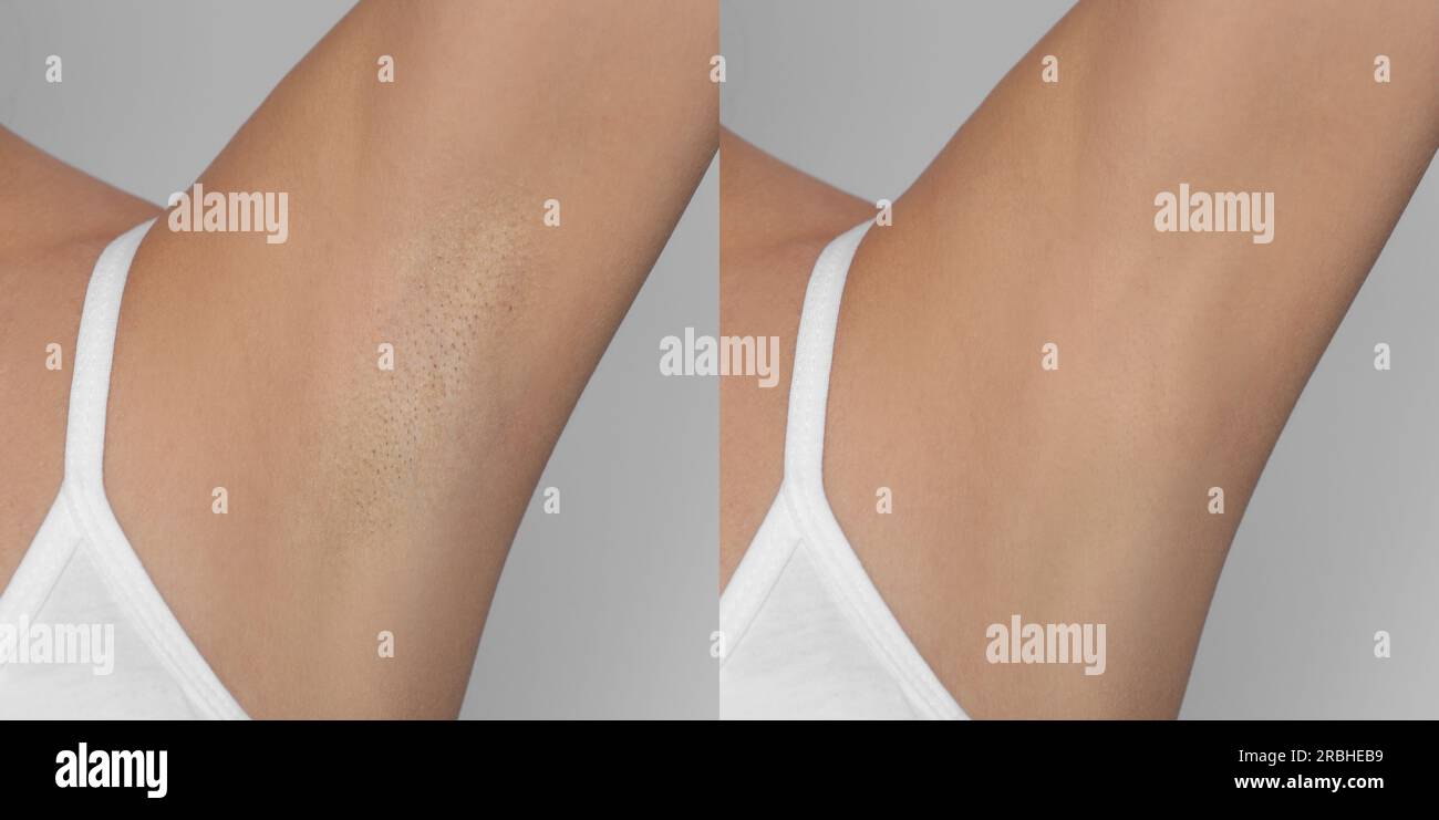 Before and after epilation. Collage with photos of woman showing armpit ...