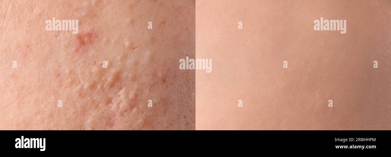 Collage with photos of person suffering from acne before and after ...