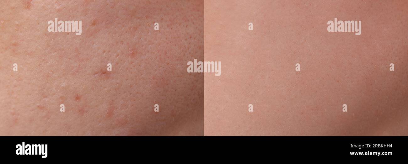 Collage with photos of person suffering from acne before and after ...