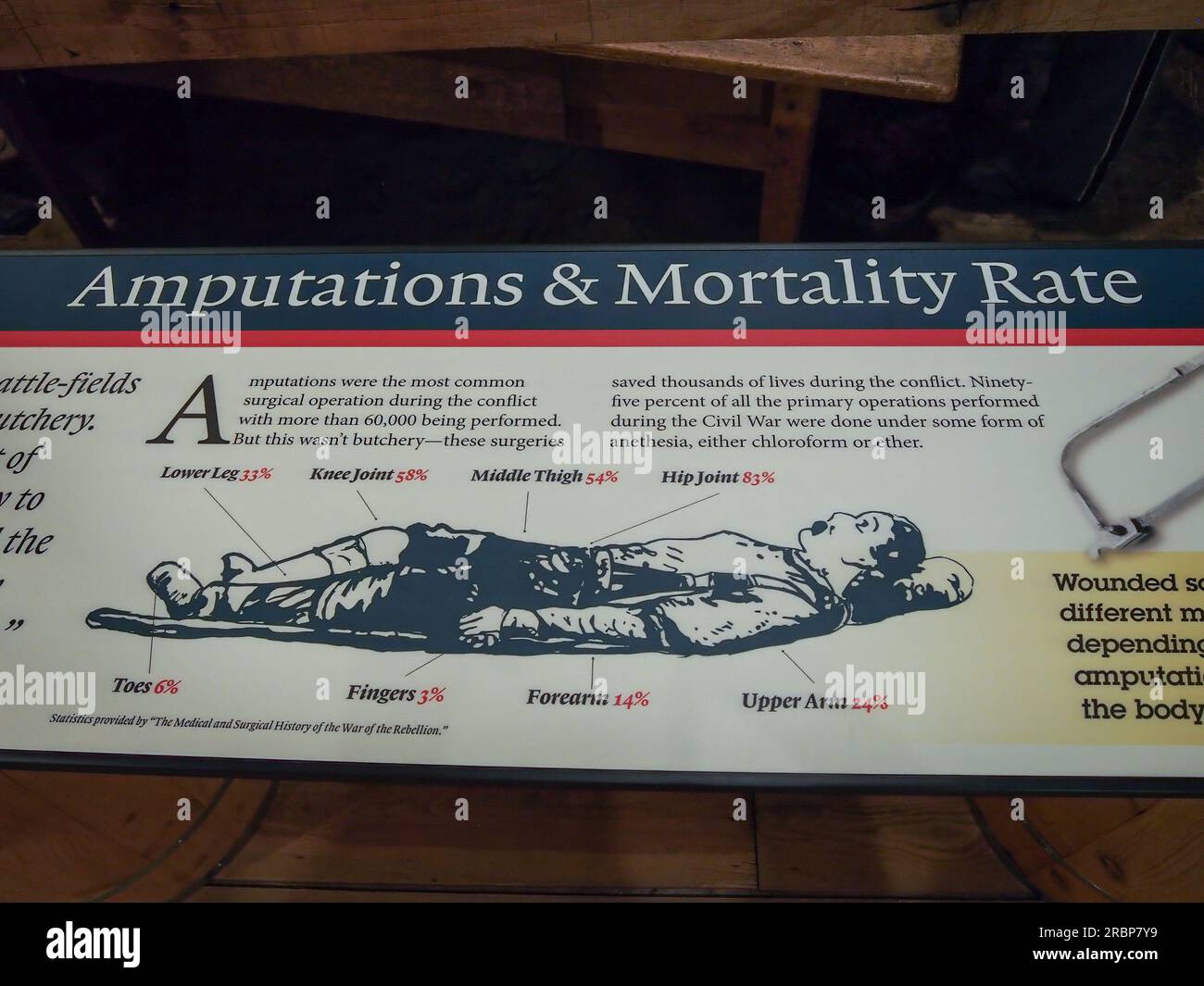 Sign illustration percentage of soldier amputations at the National ...