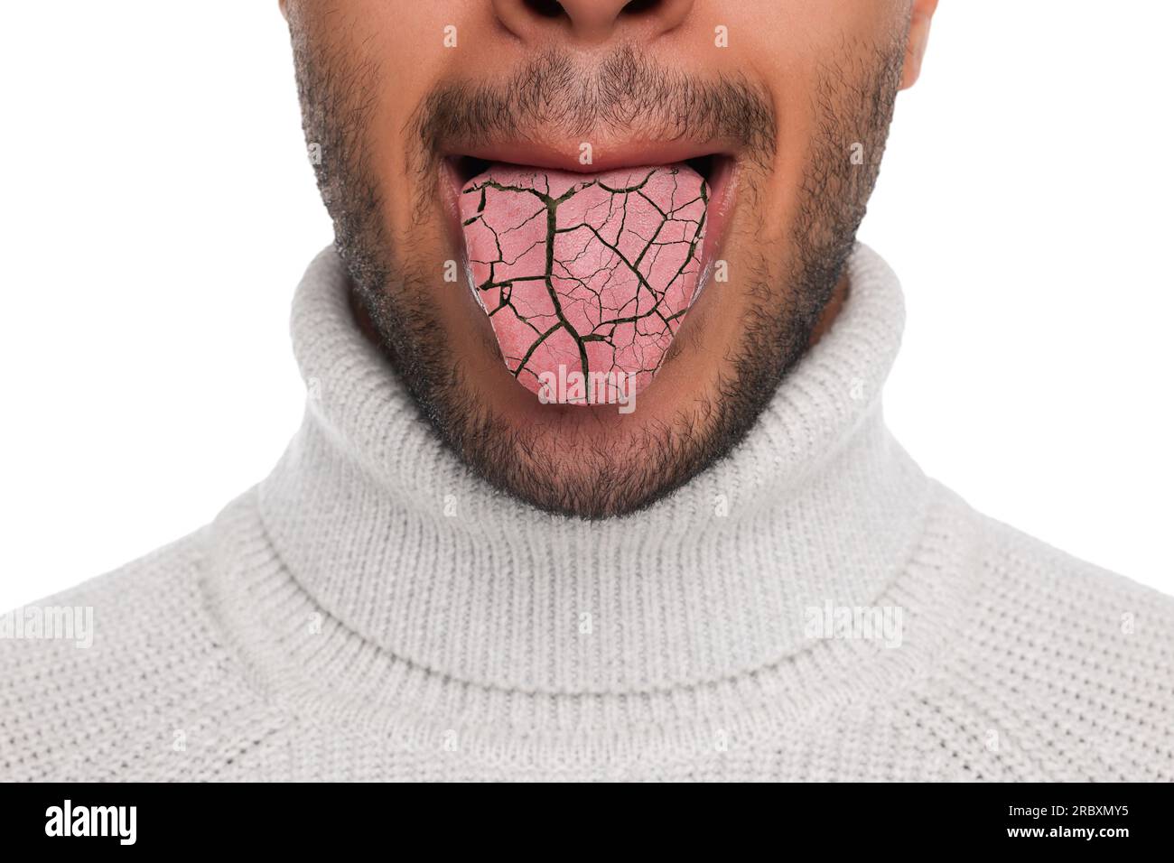Dry mouth symptom. Man showing dehydrated tongue on white background ...