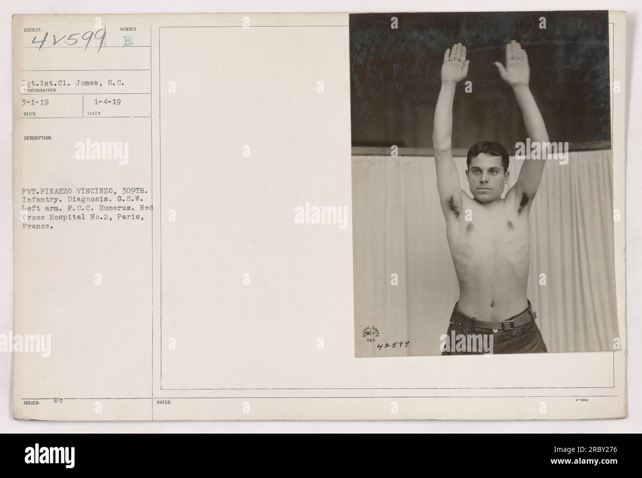 Gunshot Wound To The Arm Trauma: Transmetacarpal Gunshot Wound