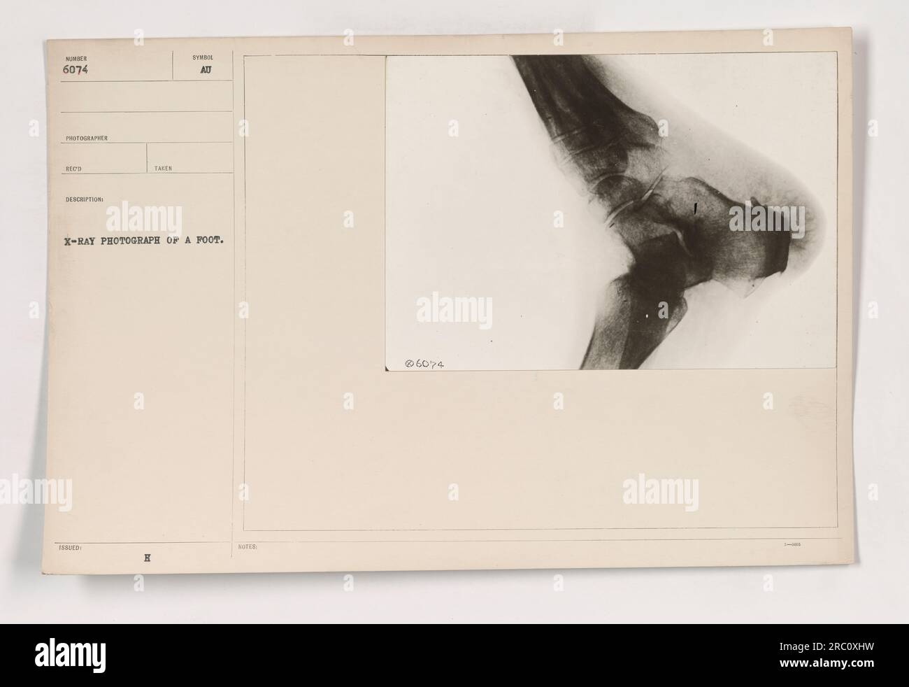 X-ray photograph of a foot taken by a photographer during World War One ...