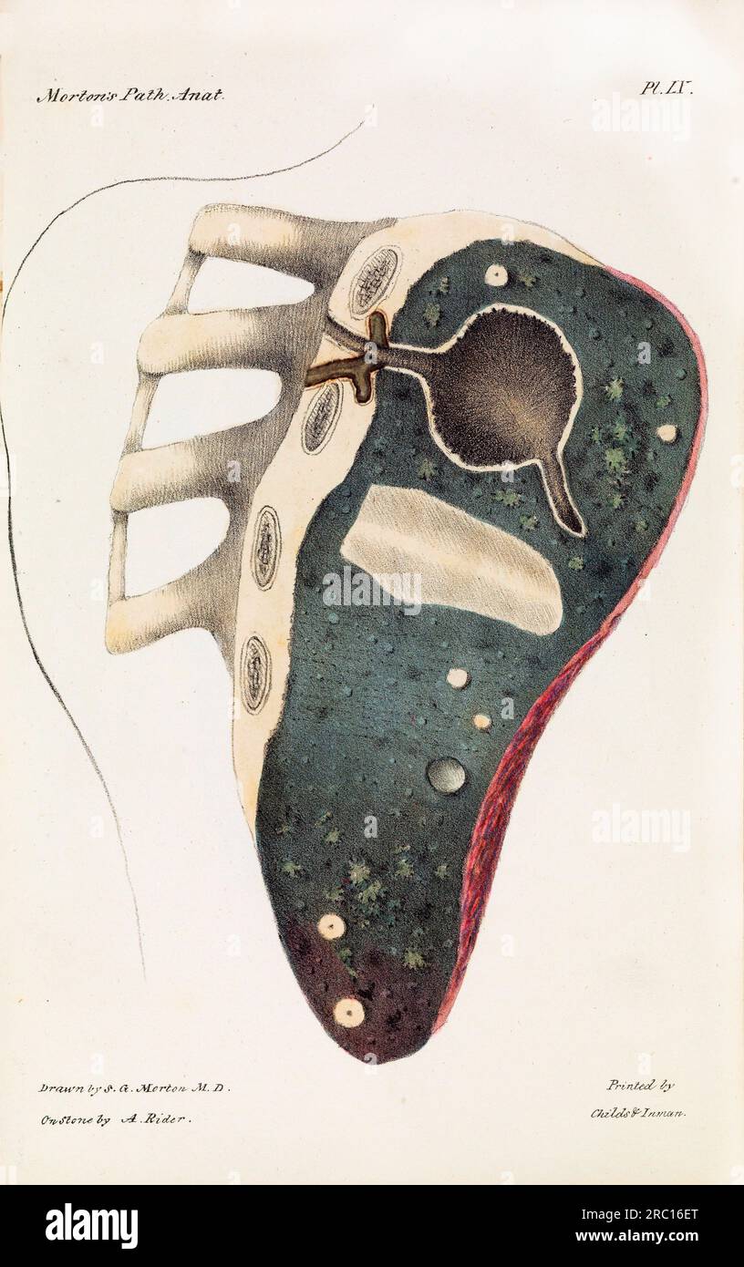 Lung infected with tuberculosis, 19th century illustration Stock Photo ...