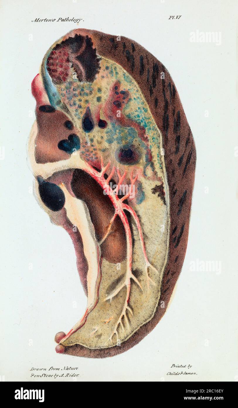 Lung infected with tuberculosis, 19th century illustration Stock Photo ...
