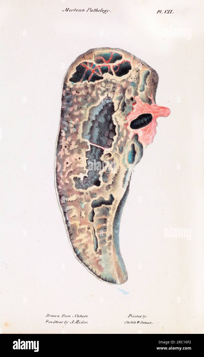 Lung infected with tuberculosis, 19th century illustration Stock Photo ...