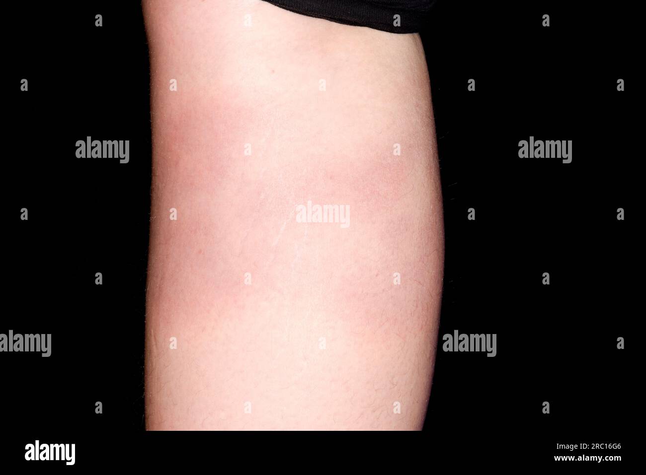 Lyme's disease rash Stock Photo - Alamy