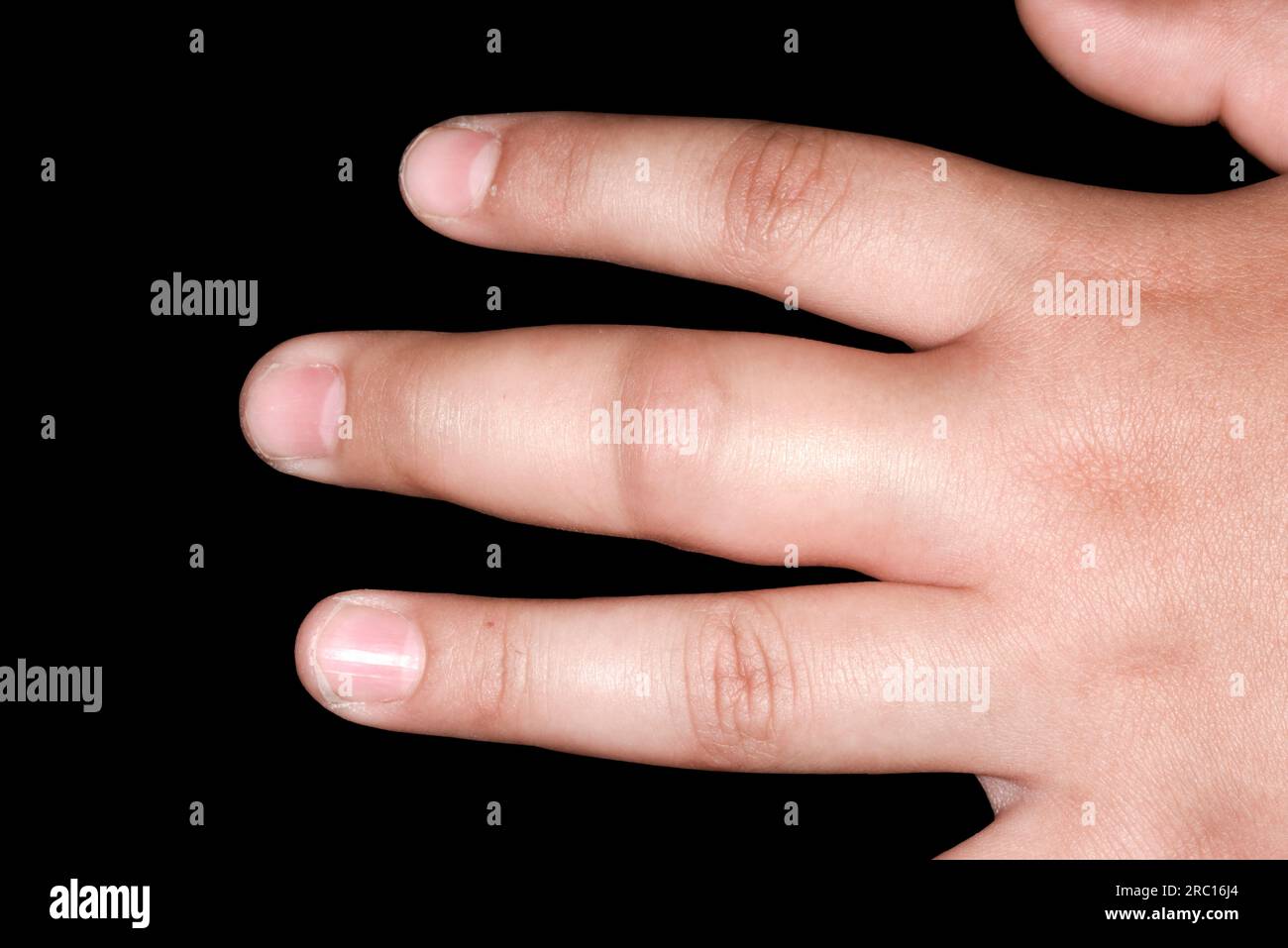 Insect sting reaction Stock Photo - Alamy