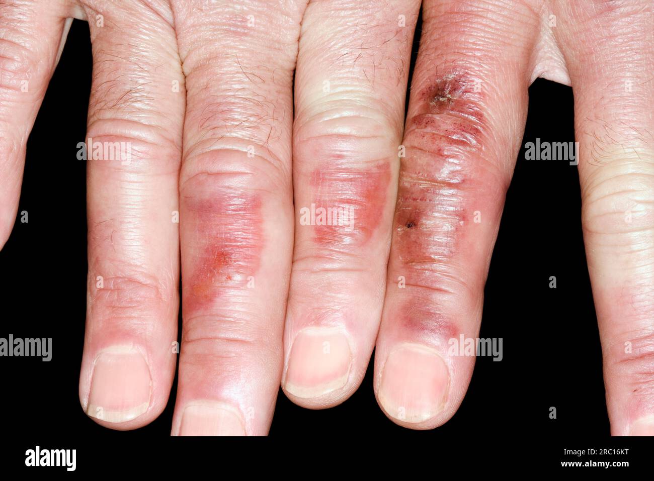 Chilblains on the fingers Stock Photo - Alamy