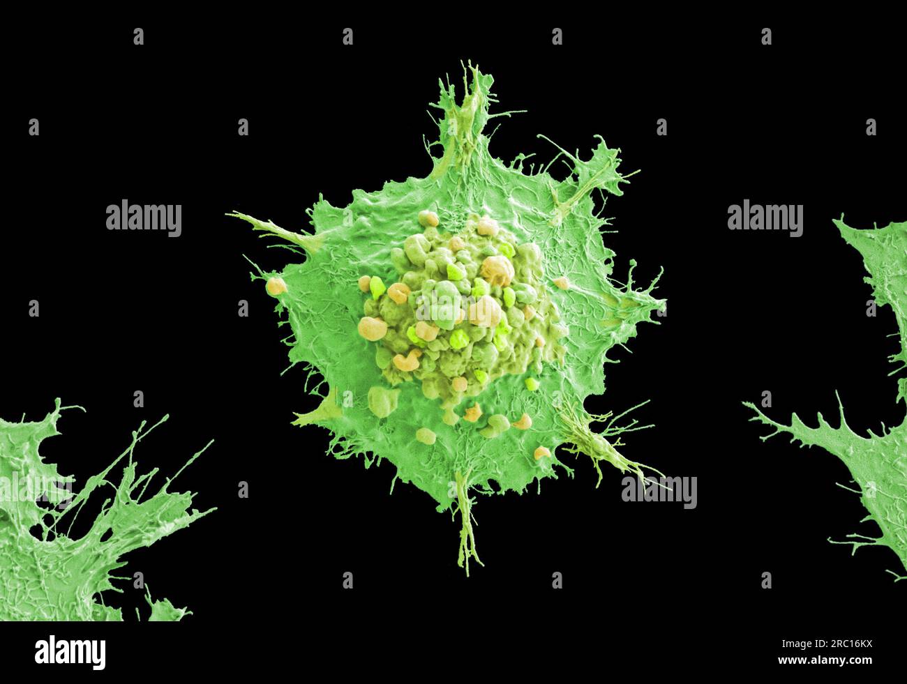 Lung cancer cells, SEM Stock Photo - Alamy