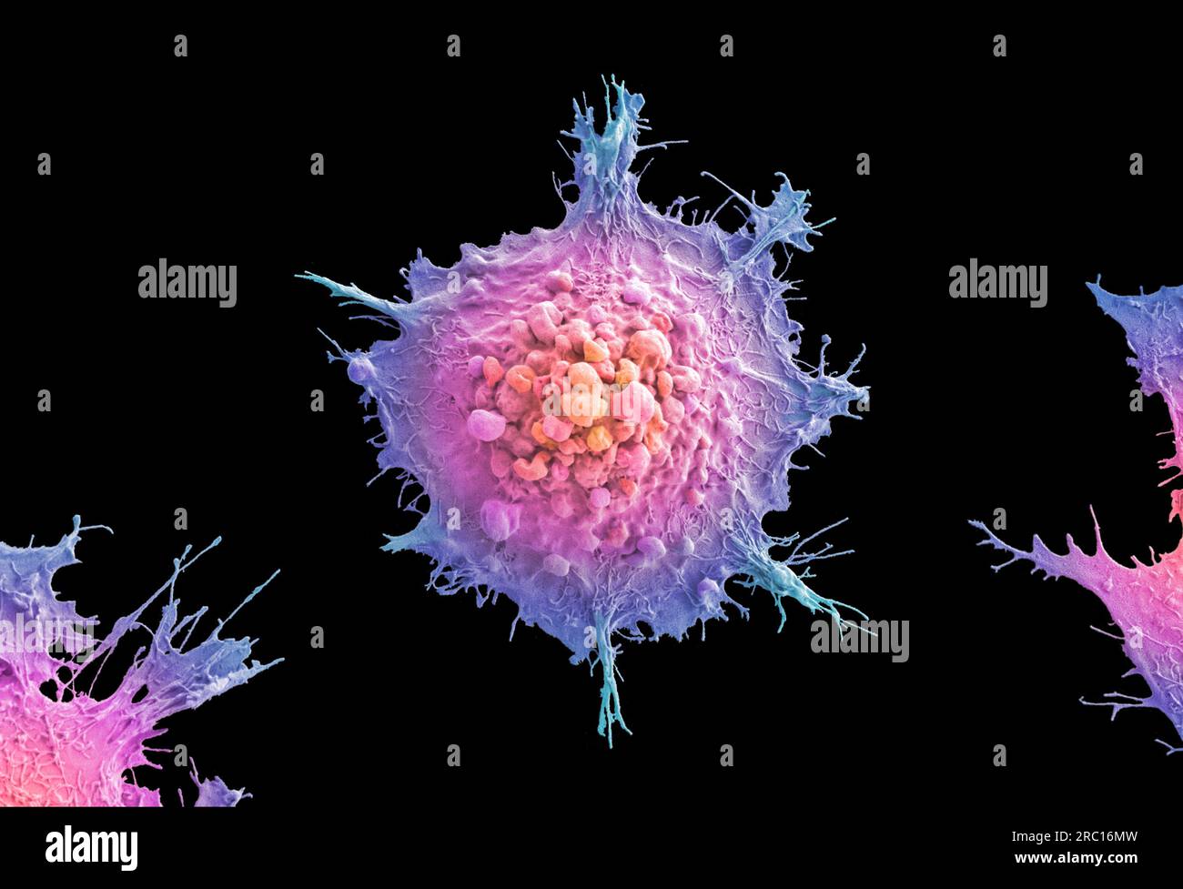 Lung cancer cells, SEM Stock Photo - Alamy