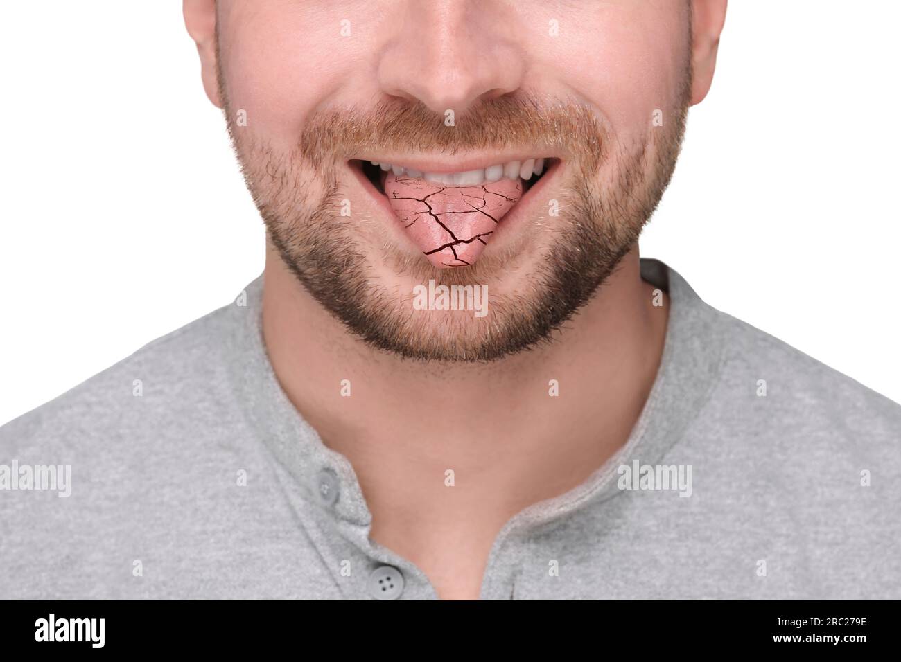 Dry mouth symptom. Man showing dehydrated tongue on white background ...