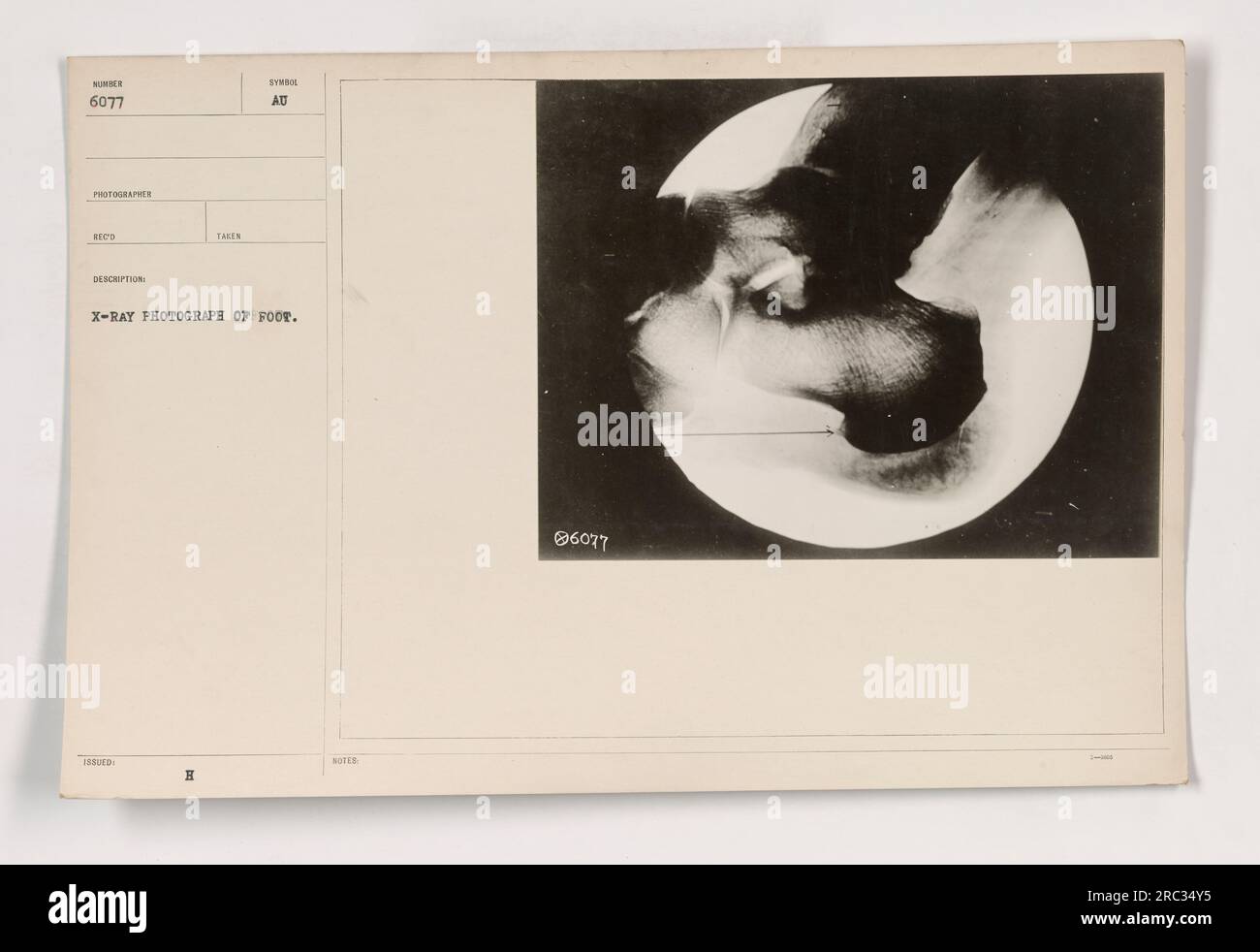 X-ray photograph of a foot taken during World War One. The image is ...