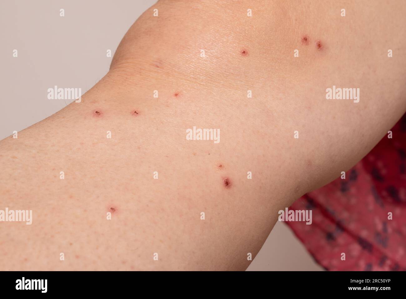 Residual chicken pox symptoms on a woman's leg. Red scabs caused by ...