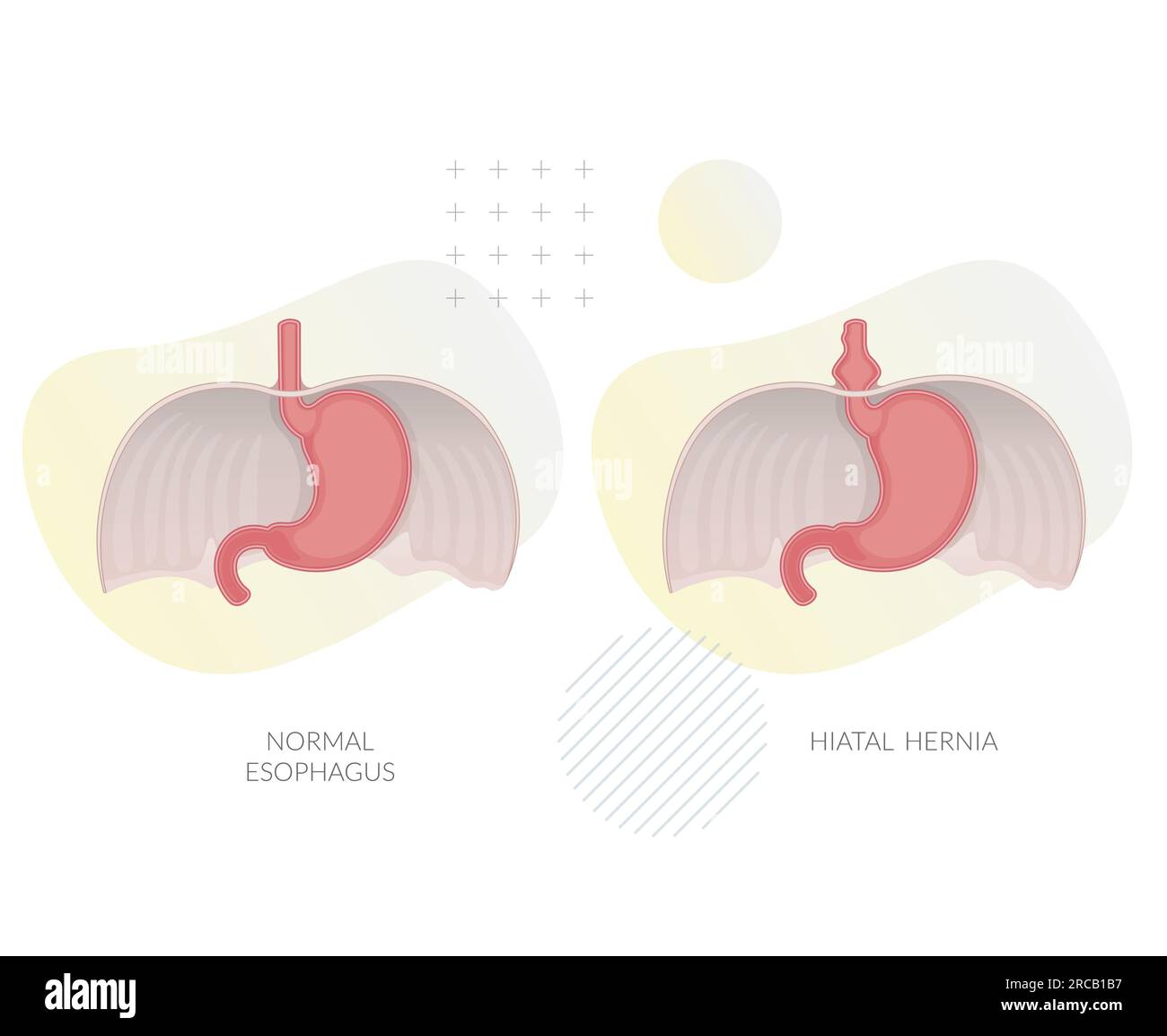Hiatal hernia hi-res stock photography and images - Alamy