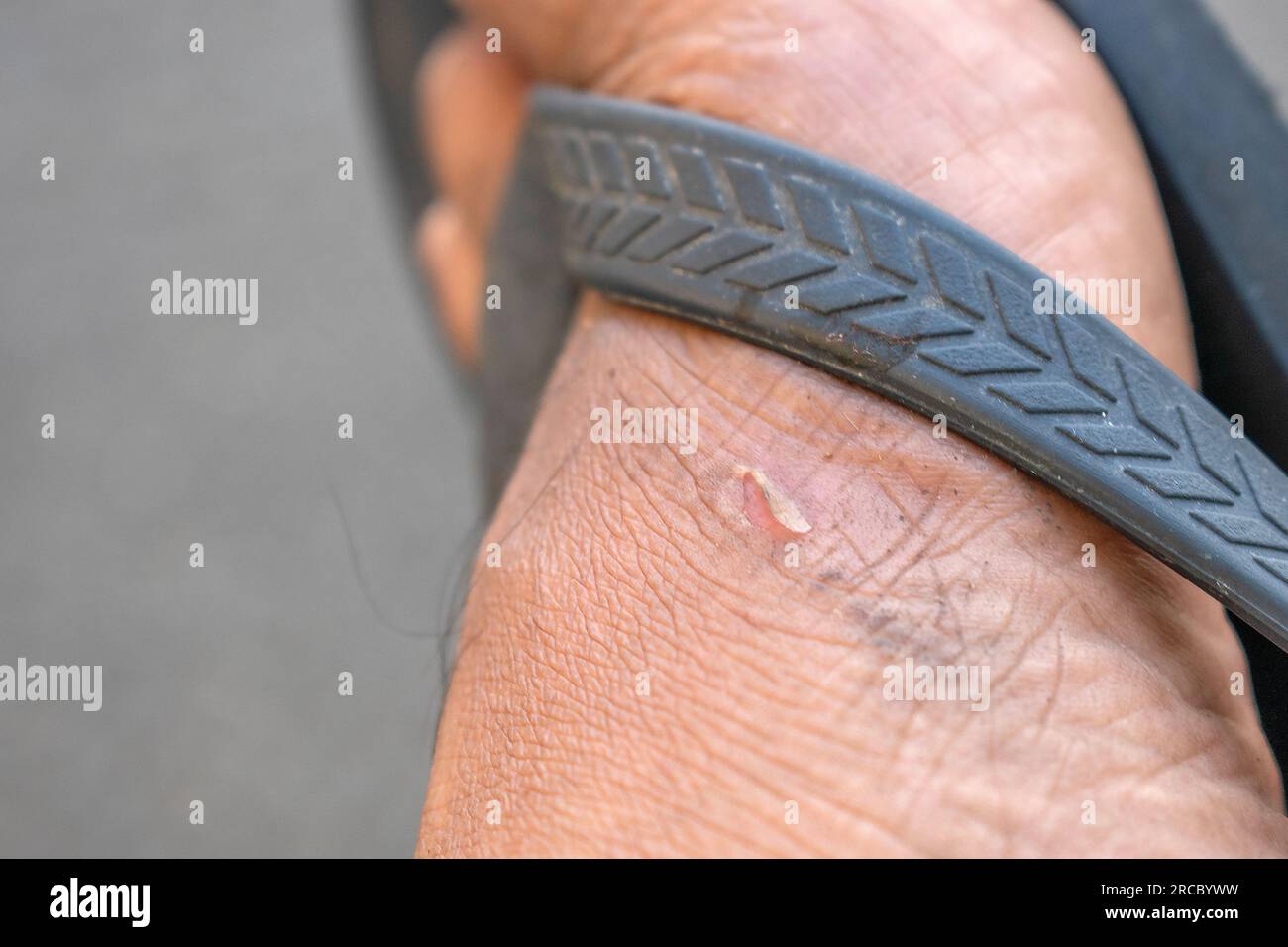 The occurrence of small, thin pieces of skin detaching from the feet as ...