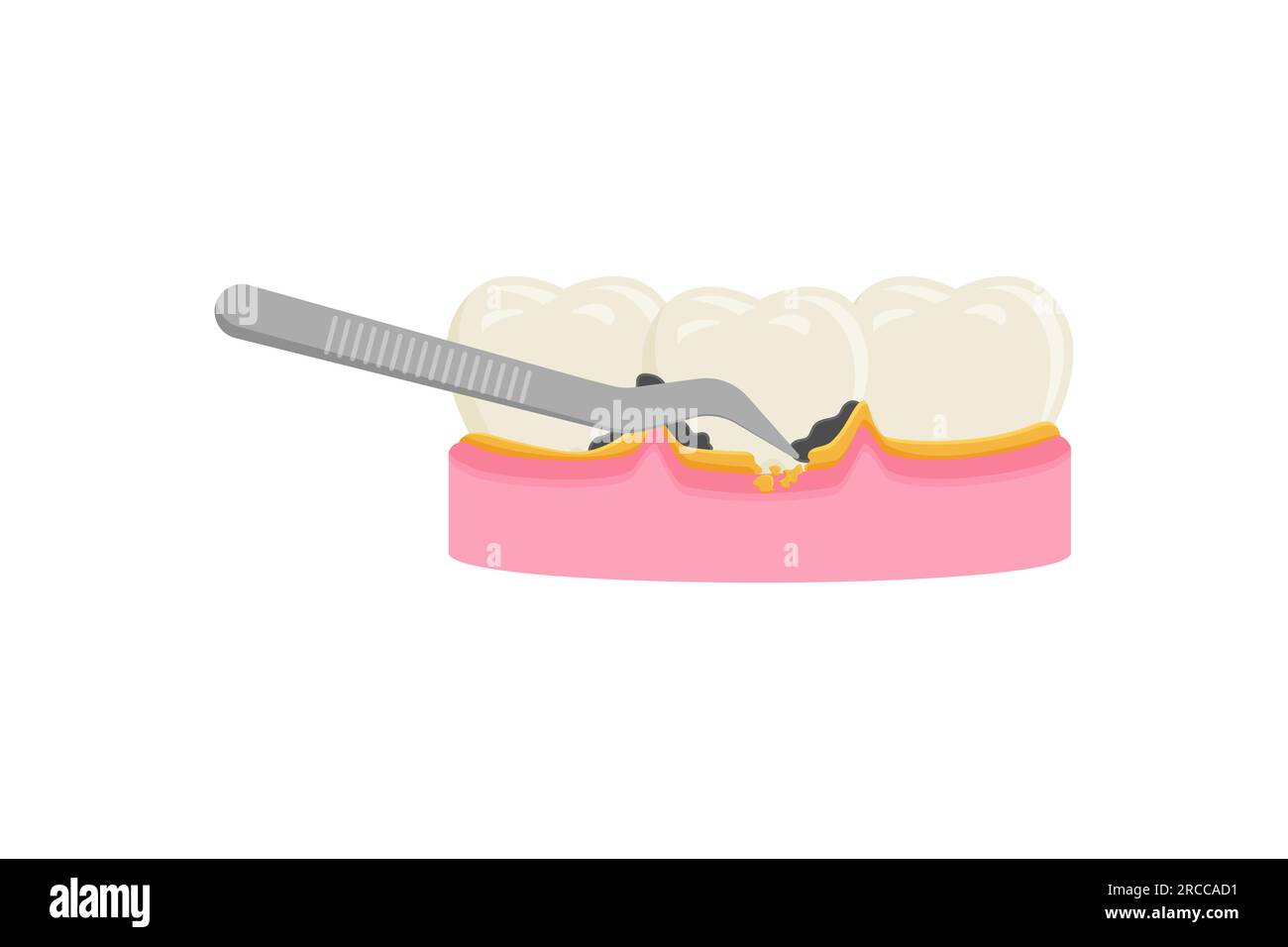 Teeth scaling, dental plaque removal for cleaning and health Stock ...