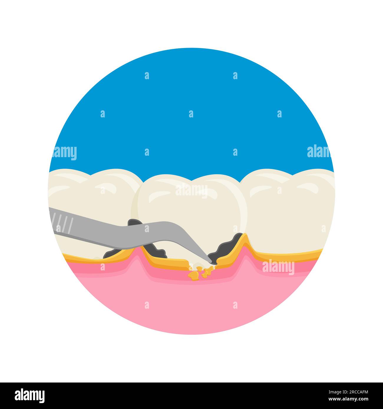 Teeth scaling, dental plaque removal for cleaning and health Stock ...