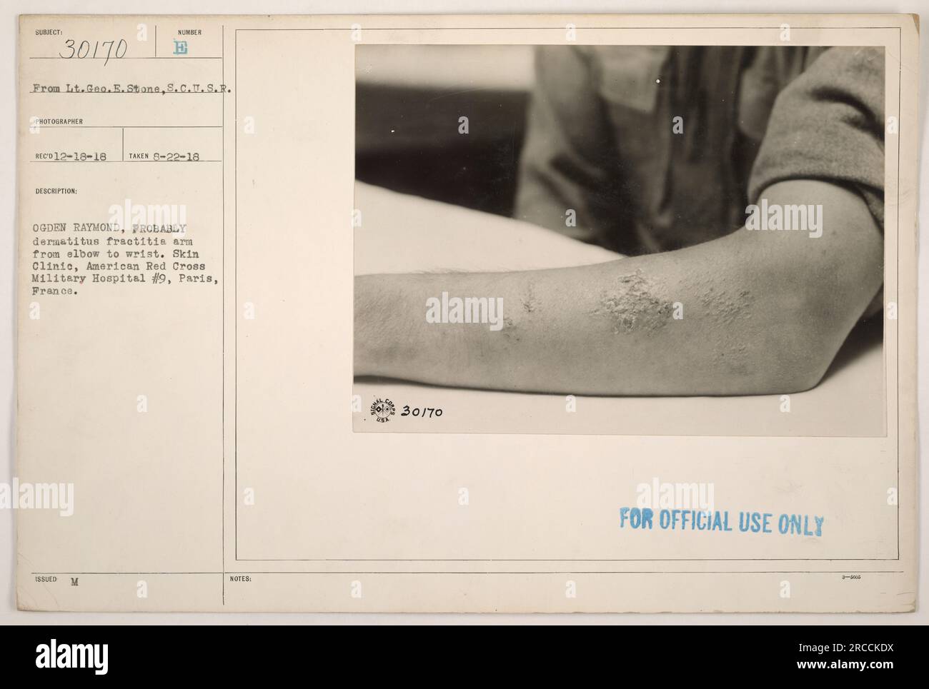 Dermatology during world war one hi-res stock photography and images ...