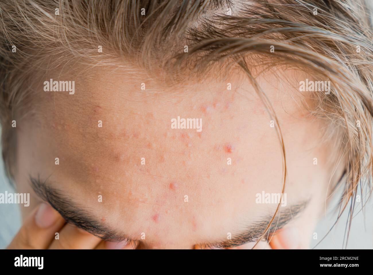 Acne on teenage boy forehead. Child is upset because of skin problems ...