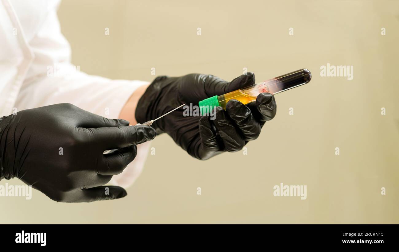 Syringe and test tube in doctor hand for PRP therapy with blood ...