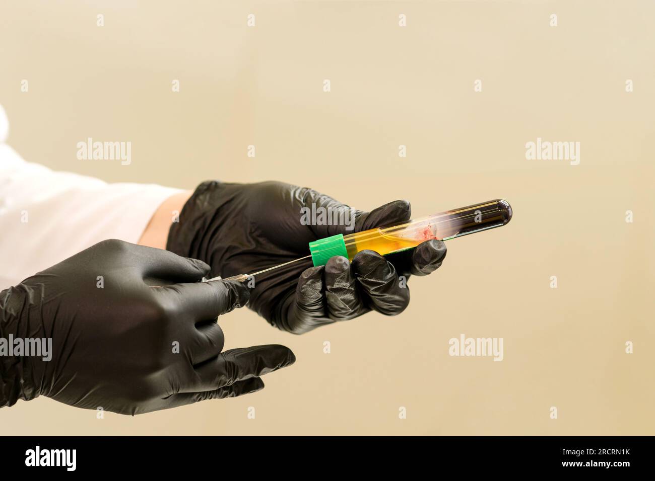 Syringe and test tube in cosmetician hand for PRP therapy with blood ...