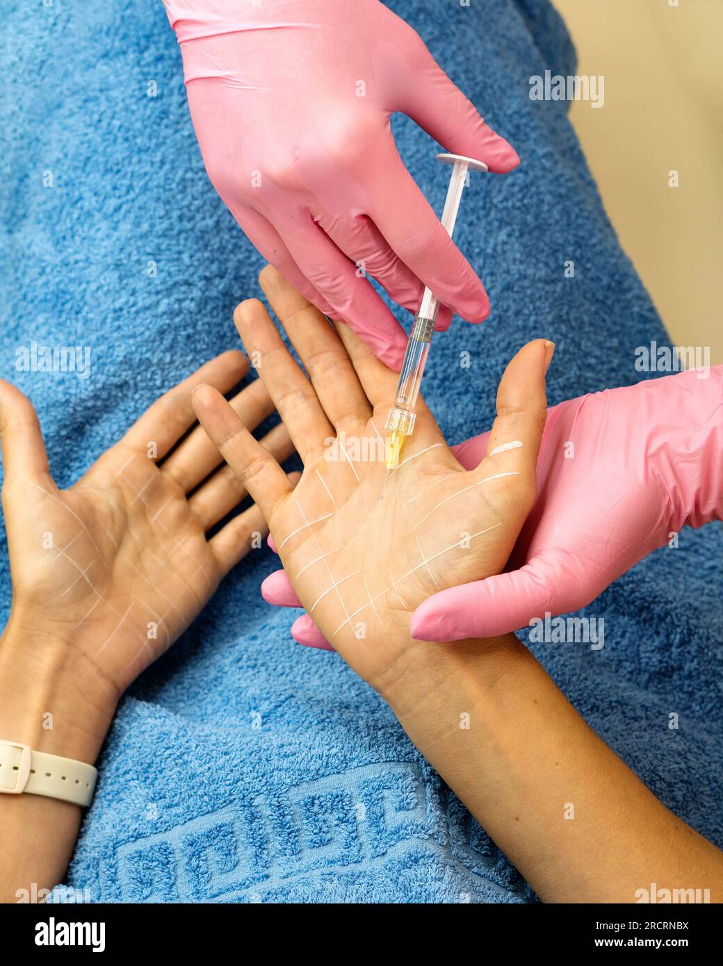 Beautician makes intramuscular injections of botulinum toxin in palm ...