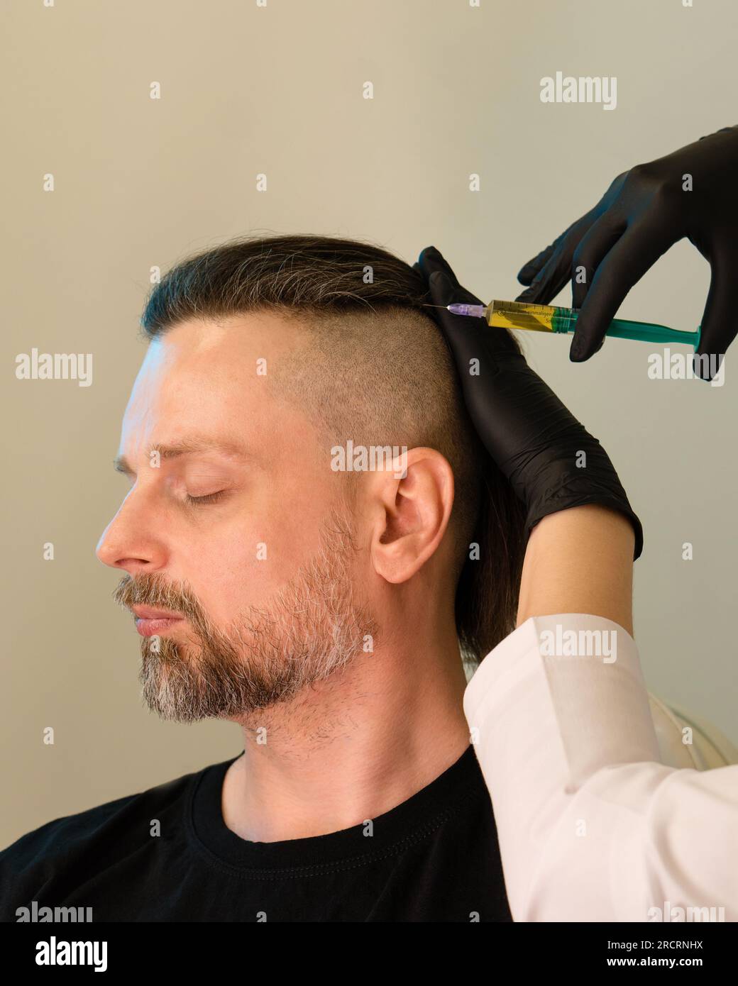 Сosmetologist uses thin needle to inject Platelet-Rich Plasma in scalp ...