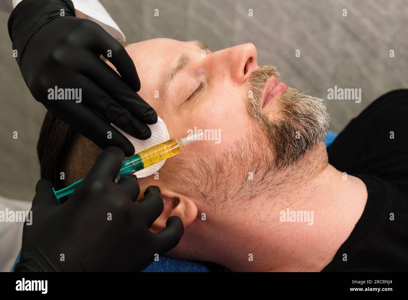 Esthetician uses thin needle to inject Platelet-Rich Plasma in skin ...