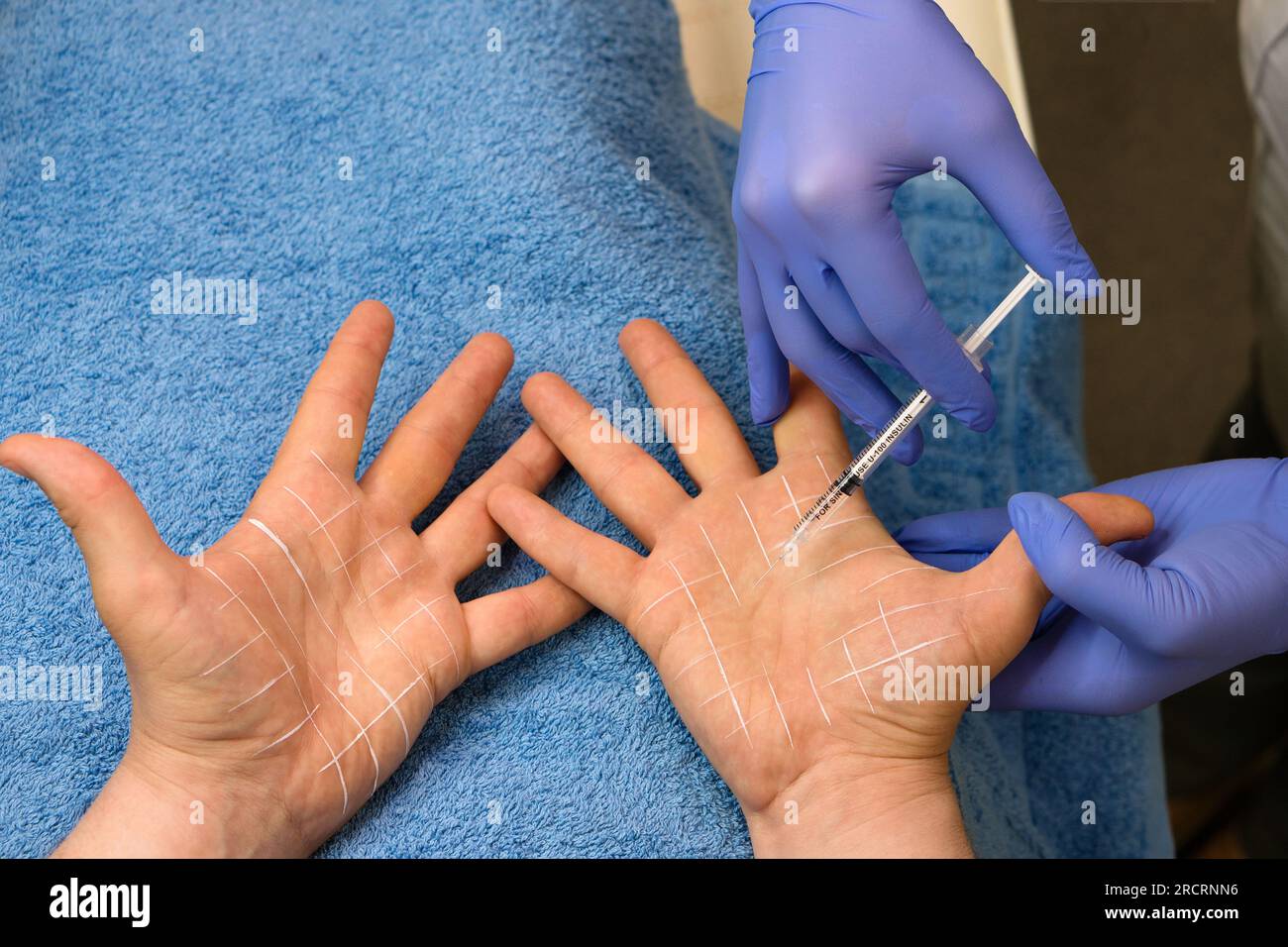 Esthetician makes injections of botulinum toxin in palm against ...