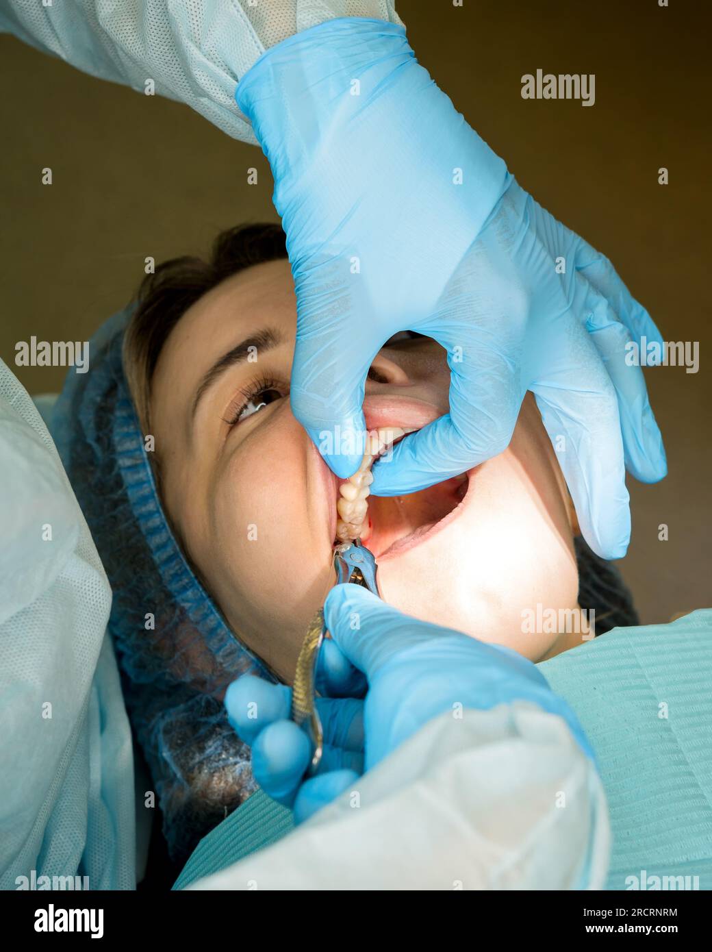 Dental surgeon removing wisdom tooth, the maxillary third molar female ...