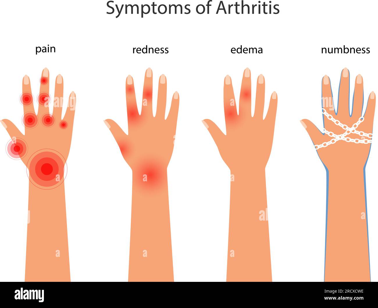 Symptoms of Rheumatoid arthritis, redness, edema, numbness. Pain in the ...