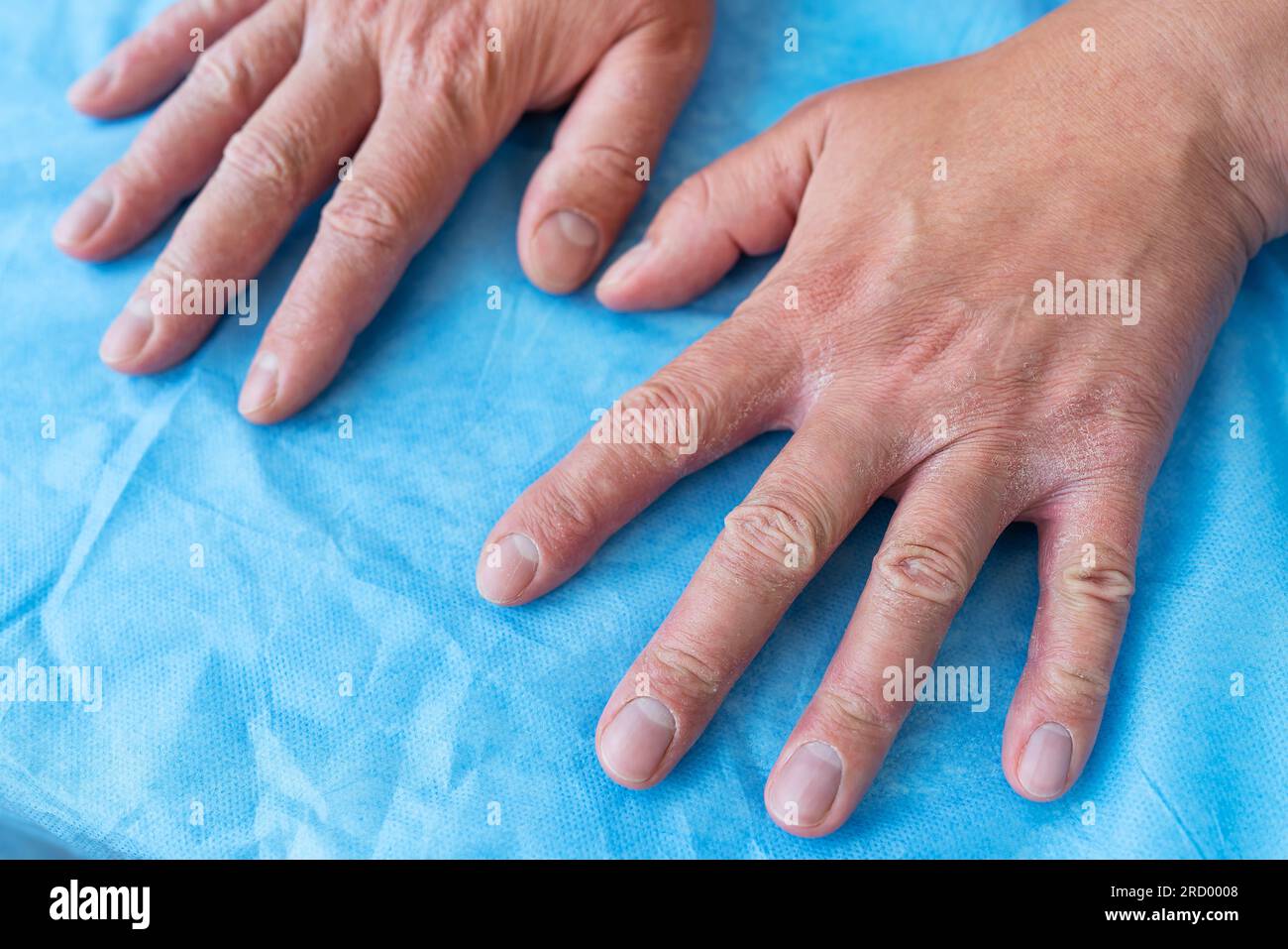 Psoriasis on the hands of a man. Dry male hand on a blue background ...