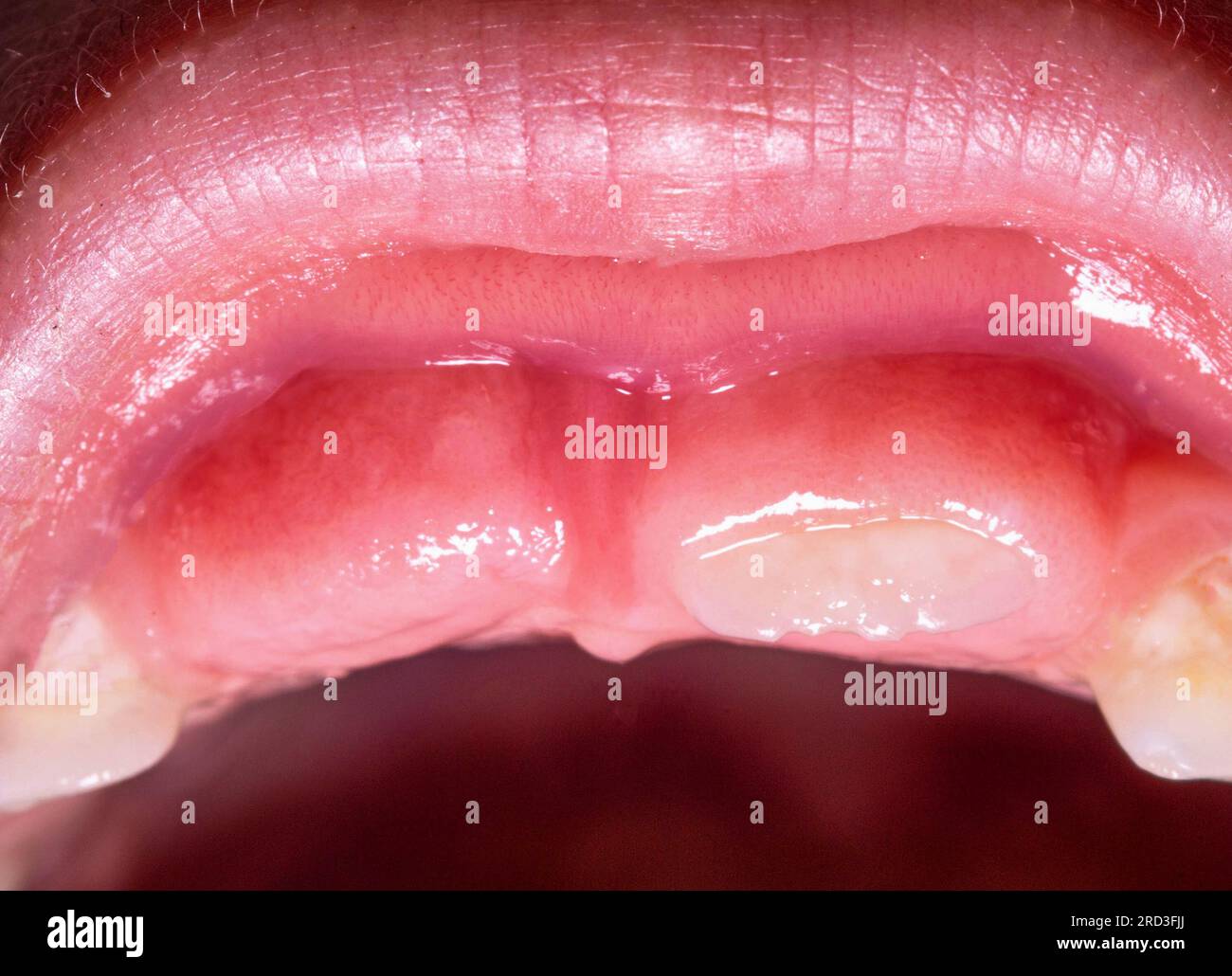 The eruption of a permanent tooth after the loss of a milk tooth in a ...