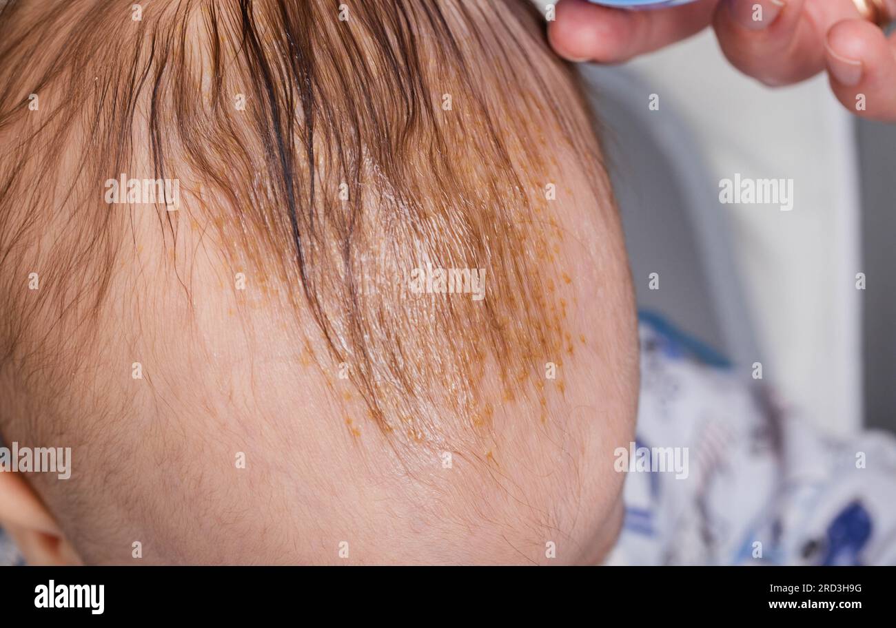 Applying a special cream and oil to the child's scalp to remove gneiss ...